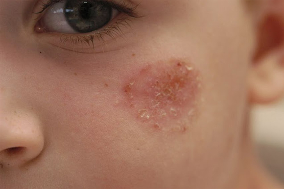 Impetigo: a infecção de pele em crianças altamente contagiosa que você ...
